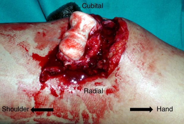 Understanding Compound Dislocation: Causes and Treatments – AssamTouch ...
